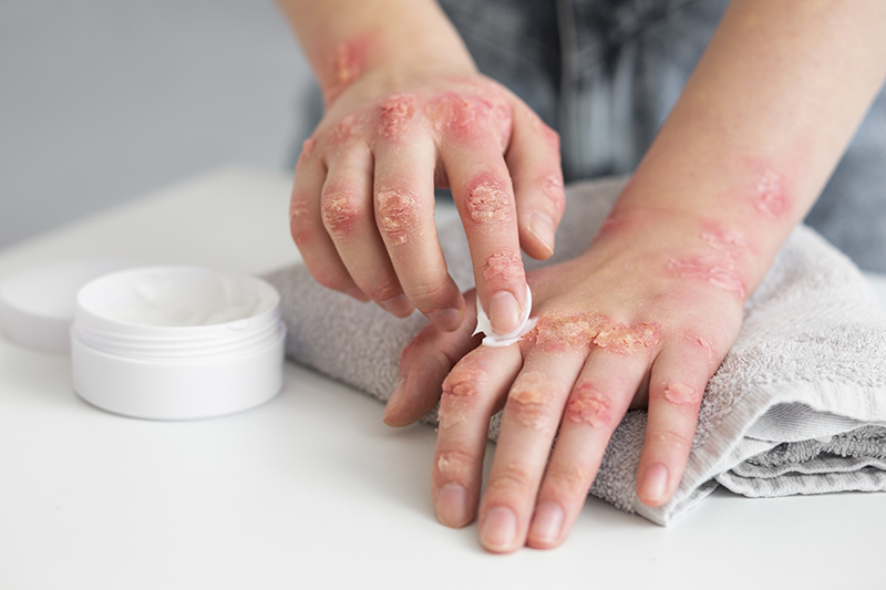 Comment se manifeste le psoriasis chez les enfants ? | Tedaria