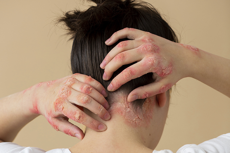 Comment se manifeste le psoriasis chez les enfants ? | Tedaria